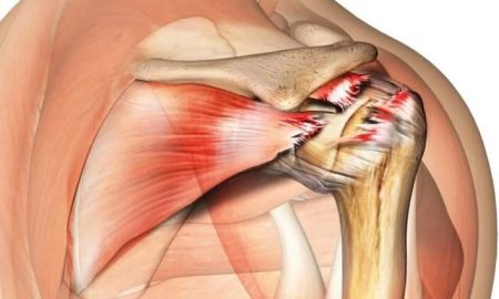 Infraspinatus Muscle: Anatomy, Function, Exercises, and Injury ...