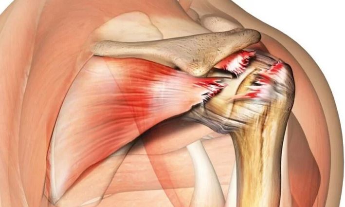 Infraspinatus Muscle: Anatomy, Function, Exercises, and Injury ...
