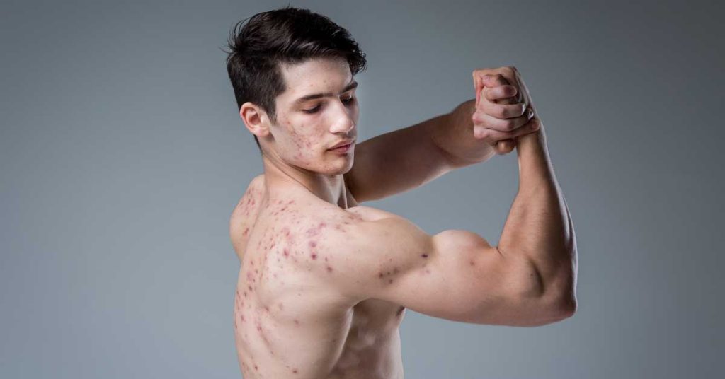 Understanding Steroid Acne: Causes, Symptoms, Treatments, and ...